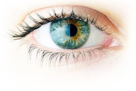 Cornea Guttata et dystrophie de Fuchs : définition et traitement