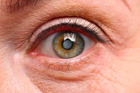 Cataracte : définition, symptômes et traitement - Dr Pierre-Maxime Lévêque